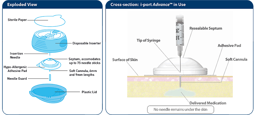 i-port Advance Injection Port | ADW Diabetes
